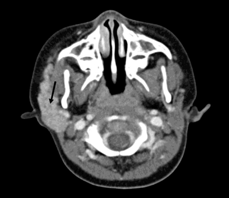 Parotid sialolithiasis in a two-year-old boy