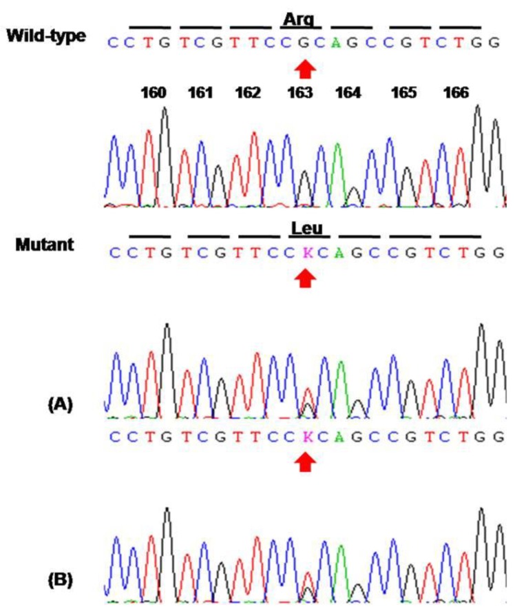 A Korean boy with atypical X-linked adrenoleukodystrophy confirmed by ...