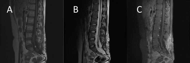 Painful legs and moving toes syndrome in a 16-year-old girl