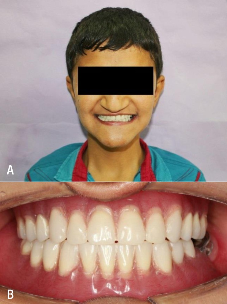 Edentulous child with Allgrove syndrome: a rare case report