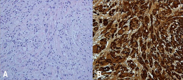 Granular Cell Tumor Colon